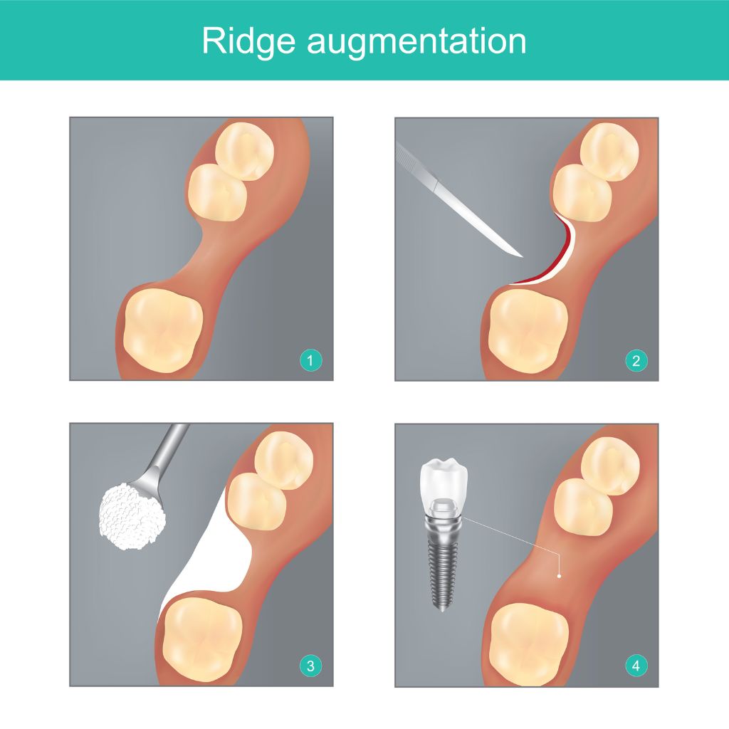 Ridge Augmentation in St. Augustine, FL